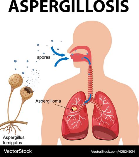 Aspergillus Diagram