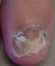 Baking Soda For Toenail Fungus Ultimate Guide