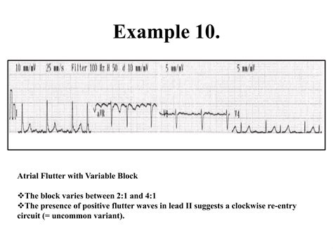 Atrial Fib And Flutter Pptx