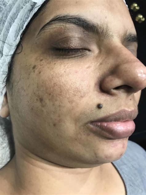 Skin Peels And Chemical Peels Treatments London Hannah London