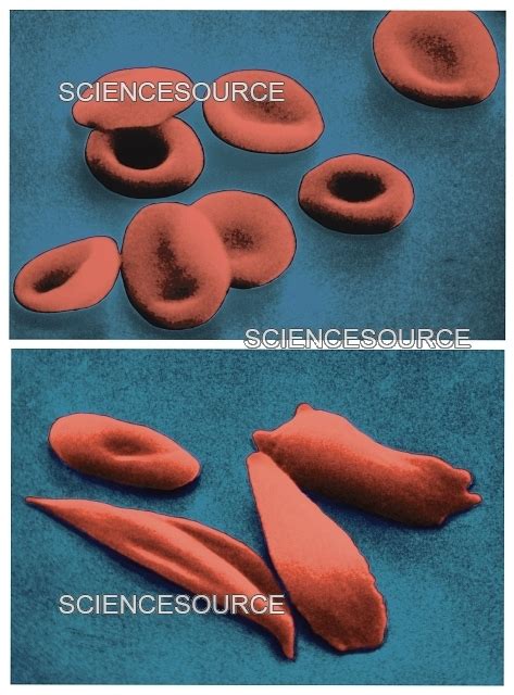 Normal Rbcs And Sickle Cell Anemia Un Stock Image Science Source