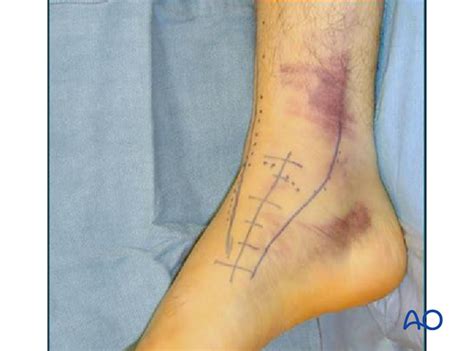 Anteromedial Approach To The Talus