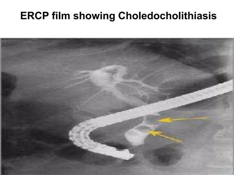 What Is Jaundice Causes Types Surgical Treatment PPTX