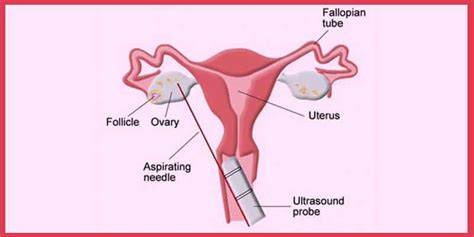 How Much Does Ovulation Induction Cost In India