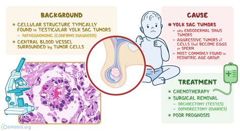 Understanding Endodermal Sinus Tumour Causes Symptoms And Treatment