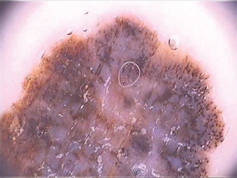 Illustrative Examples Of Dermoscopic Images A C E G And I And