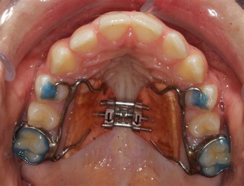 Palatal Expanders Why How And When Orthodontist Vaughan Braces