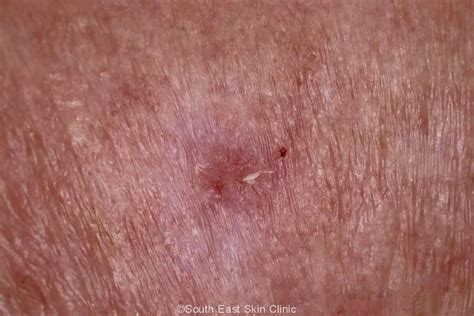 Bcc Basal Cell Carcinoma