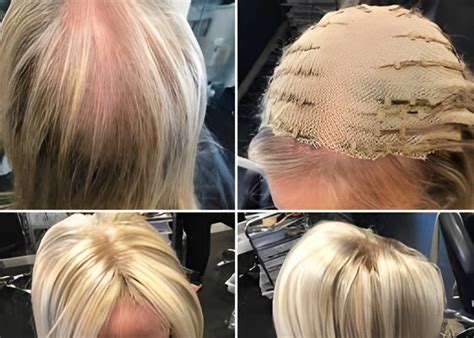 Mesh Integration Hair System Best Solution For Hair Loss