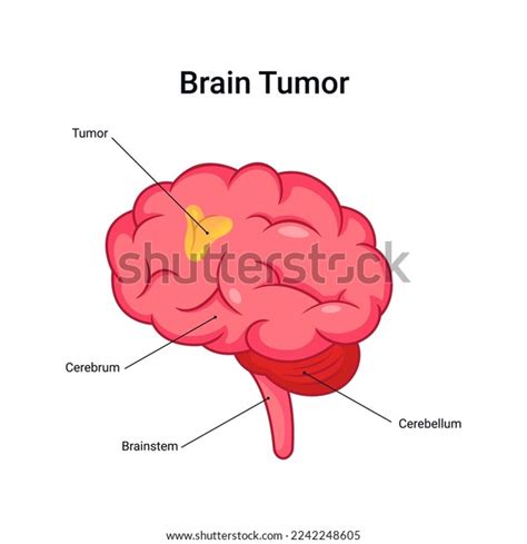 Brain Tumor Disease Diagram Medical Illustration Stock Vector Royalty Free