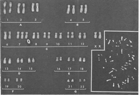 Figure 2 From Familial Trisomy 7 Mosaicism Summary A Trisomy