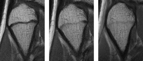 Ossification Progress For Subject No 26 For Time Points Bl 16 0