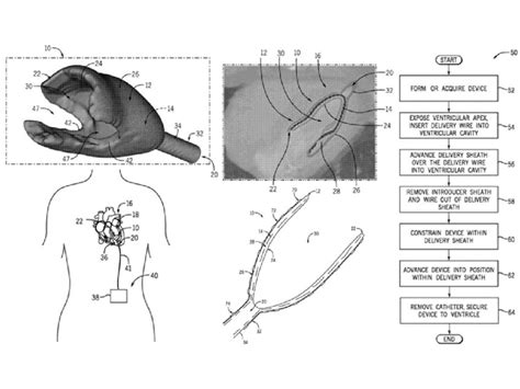 Researchers Develop Intracardiac Pulsatile Ventricular Assist Device Bioworld