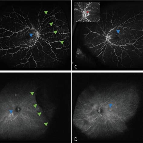 Fluorescein Angiography Fa And Indocyanine Green Angiography Icga