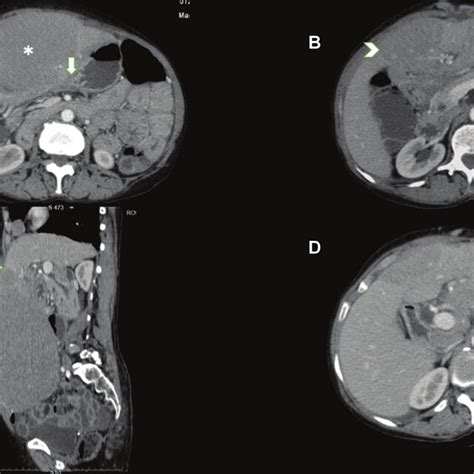 Axial And Sagittal Cect Images A C Showing A Large Homogenous