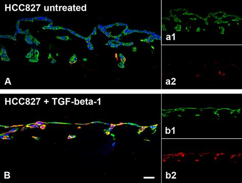 A Combined 3d Tissue Engineered In Vitro In Silico Lung Tumor Model For