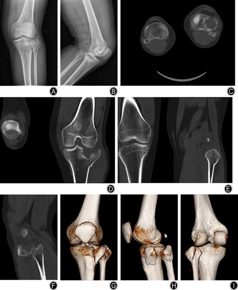 Proximal Tibia And Fibula