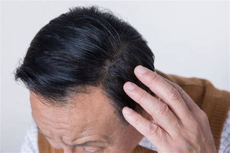 헬스s 호환 마마보다 무서운 가을 탈모 소중한 머리카락 지키려면 머니s