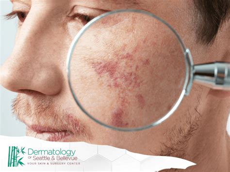 Choosing The Right Method For Skin Cancer Removal On The Nose
