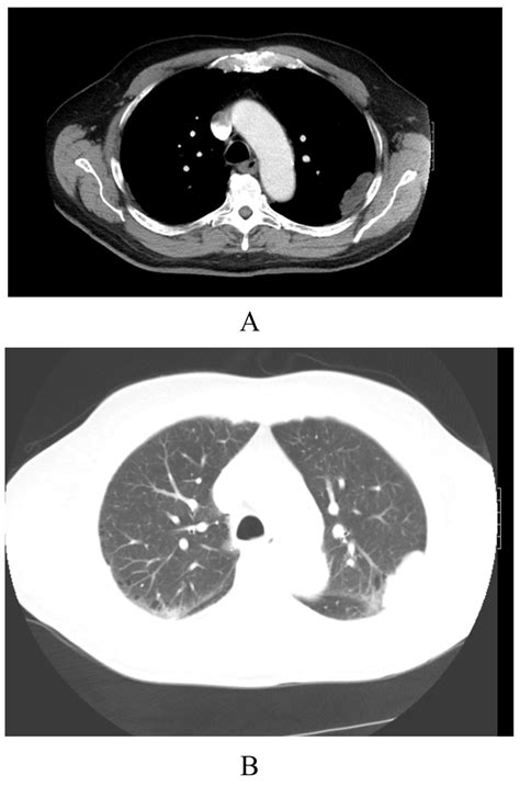 Axial Ct Scan Of Left Upper Lobe Mass Mediastinal Window Panel A And