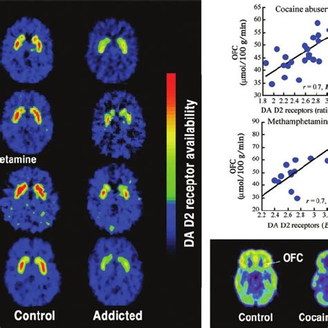 Role Of Dopamine D2 Receptors In Obesity A Dopamine D2 Receptors