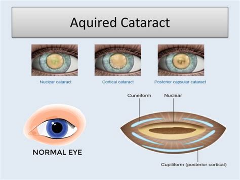 Types Of Cataract Pptx