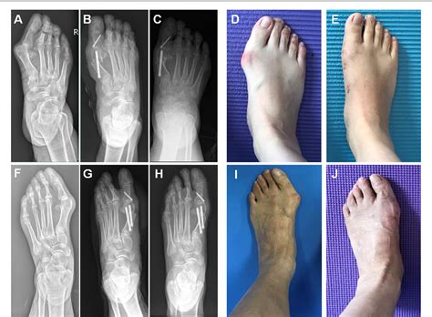 First Metatarsal Single Screw Minimally Invasive Chevron Akin Osteotomy