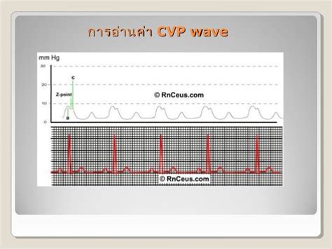 Cvp Central Venous Pressure Monitoring