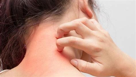 التهاب الجلد التماسي الأعراض والأسباب وطرق الوقاية والعلاج