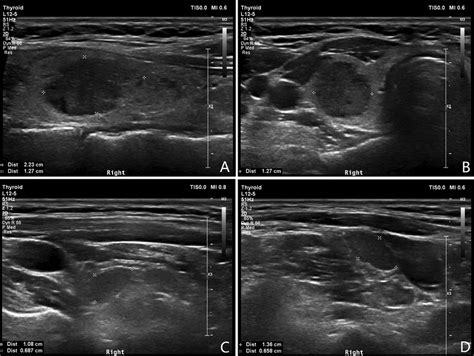 Characteristic Sonographic Features Of Medullary Thyroid Carcinoma And