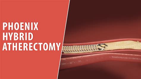 Phoenix Hybrid Atherectomy Demo Trusted Patient Education Platform