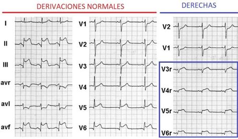 Derivaciones Derechas Y Posteriores Del Electrocardiograma