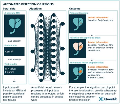 The Ultimate Guide To Ai In Prostate Cancer