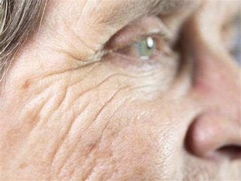 Actinic Keratosis Balmonds