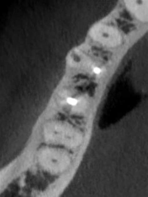 Conventional Endodontic Treatment With Surgical Repair Of External Resorptive Defect Root