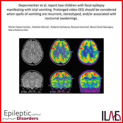 Epileptic Disorders Linkedin‘de Depermentier Et Al Report Video Eeg