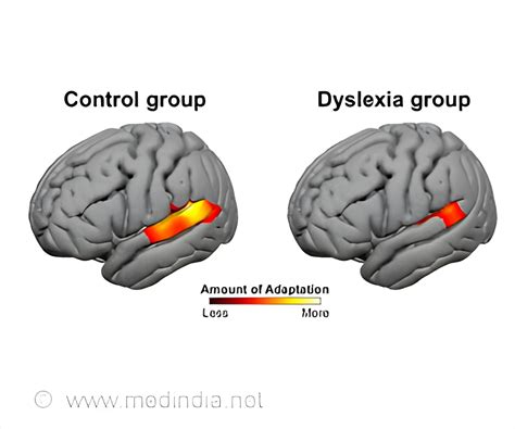 How Dyslexia Genes Shape Brain Structure