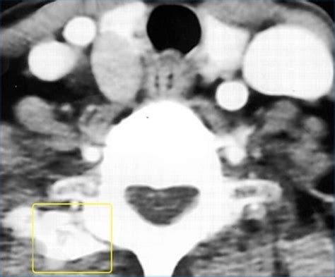 Contrast Enhanced Axial Ct Scan Image Showing The Parathyroid Lesion