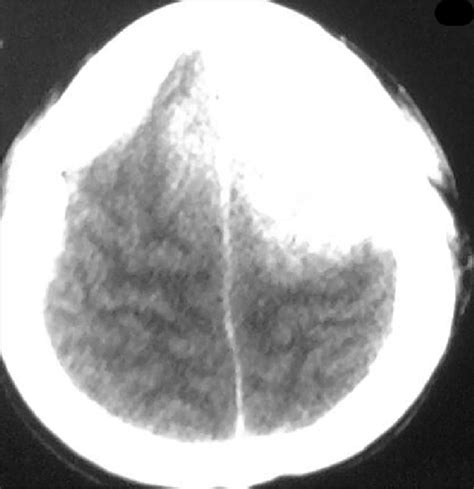 Brain Ct Showing Biconvex High Density In Vertex Download Scientific