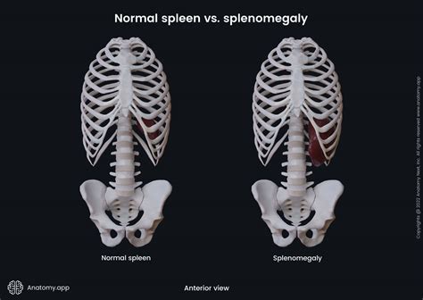 Normal Spleen Vs Splenomegaly Anatomyapp