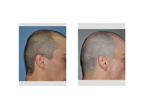 Occipital Bone Lump
