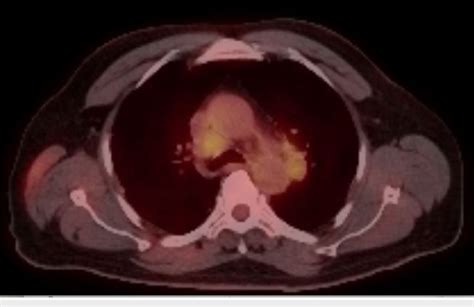 Petct Showing Hypermetabolic Mediastinal Lymph Nodes In The Precarinal