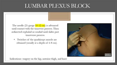 Lumbar Plexus Block