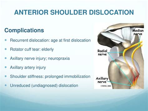 Ppt Acute Joint Dislocation Powerpoint Presentation Free Download