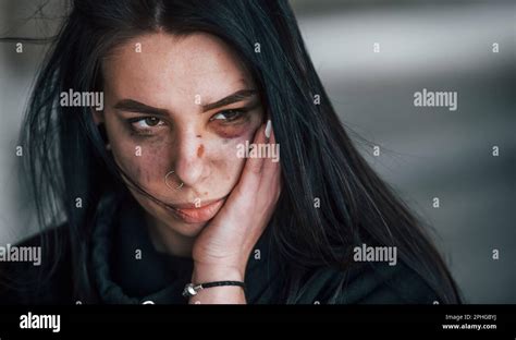 Portrait Of Beaten Young Woman With Bruise Under Eye Indoors In