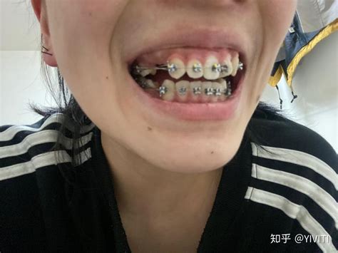 记录我在上海正畸矫正牙整牙的过程 知乎