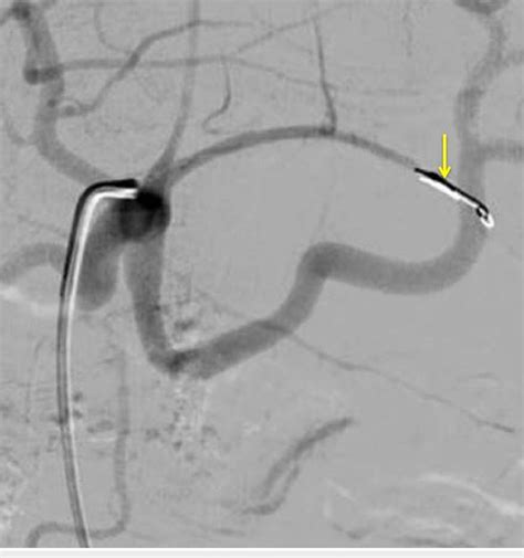 Digital Subtraction Angiography Showing Coil Embolization Of The Left