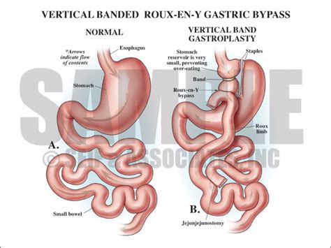 Vertical Banded Gastroplasty Before And After