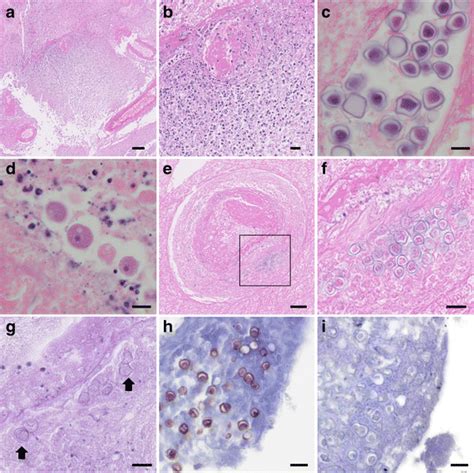 A Case Report Of Granulomatous Amoebic Encephalitis By Group 1 Acanthamoeba Genotype T18