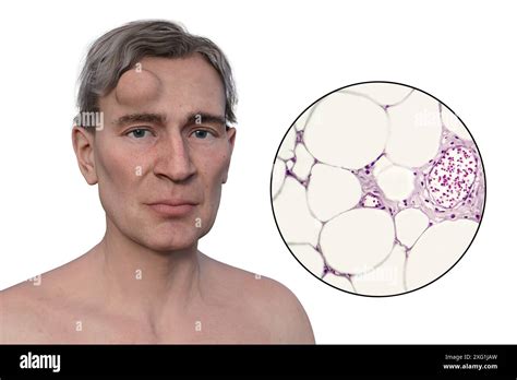 Illustration Of A Man With A Lipoma On His Forehead And Close Up View